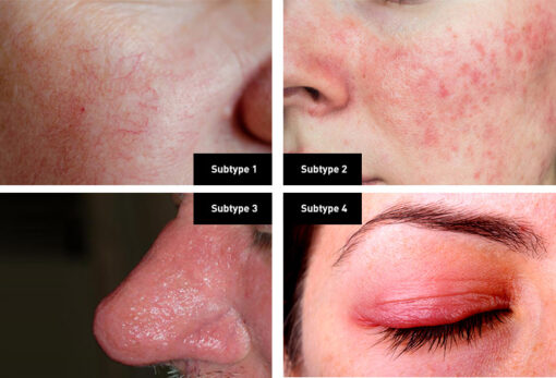 Light therapy for rosacea - Red Light Man